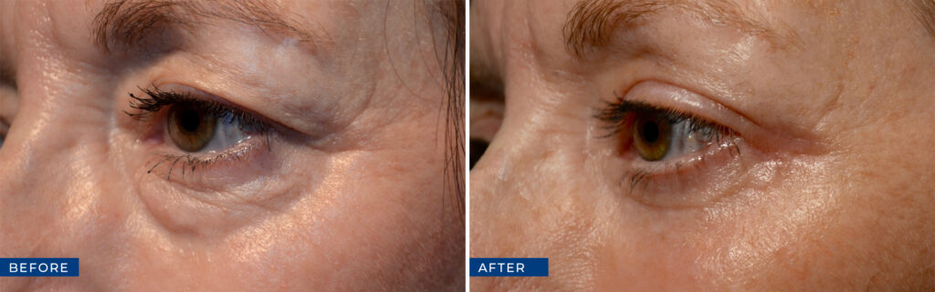 Oculoplastic Surgery Before and After Gallery - Eye Care Associates of ...