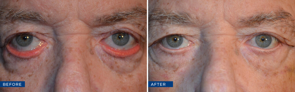 Oculoplastic Surgery Before and After Gallery - Eye Care Associates of ...