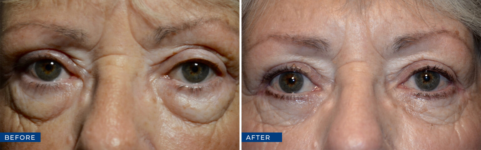 Oculoplastic Surgery Before and After Gallery - Eye Care Associates of ...