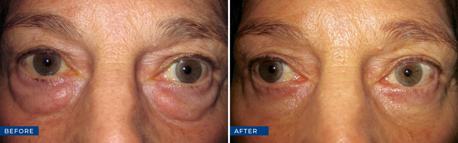 Oculoplastic Surgery Before and After Gallery - Eye Care Associates of ...